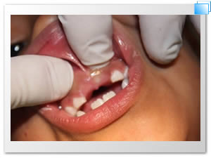 Ojal Quirúrgico (Ulectomia)