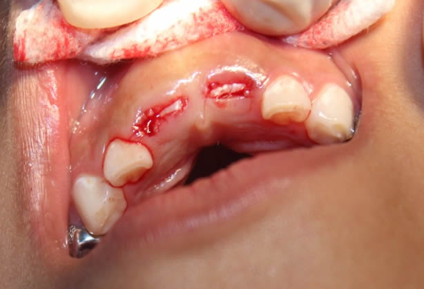 Ojal Quirúrgico (Ulectomia)